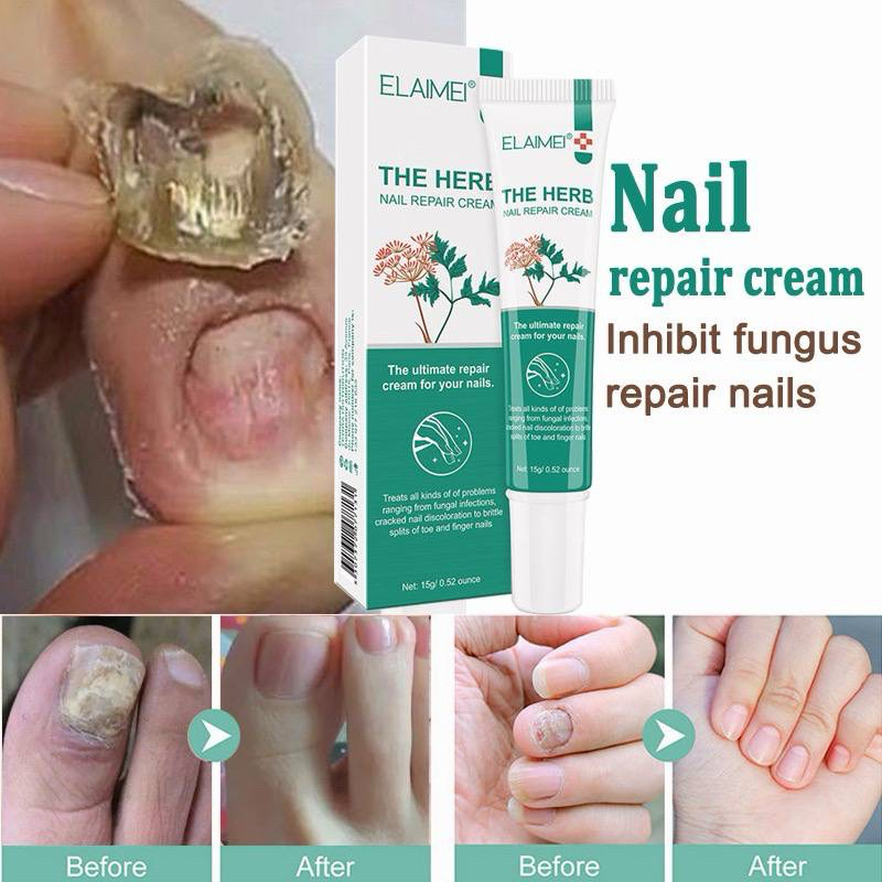 ELAIMEI nail repair Merawat masalah kuku jangkitan kulat kuku retak ...