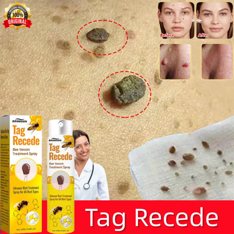 Ubat Ketuat Tahi Lalat Remover Wart Remover Ubat Kutil Buang Tahi Lalat ...