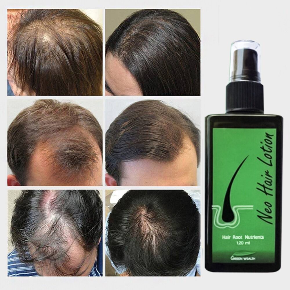 Neo Hair Lotion nourish hair roots, and generate new hairs | Shopee ...