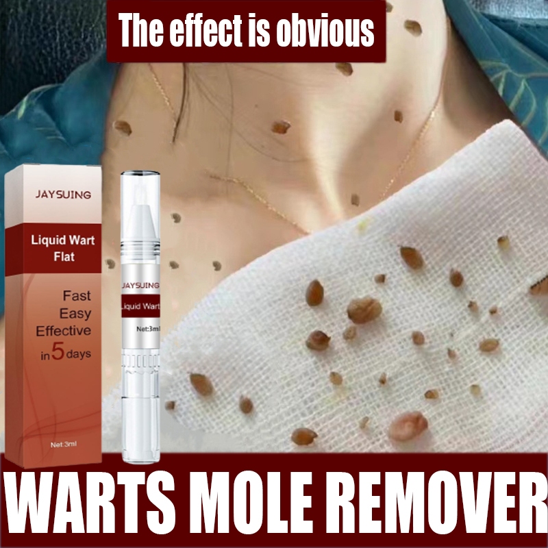 Wart Removal Liquid Pen Ubat Ketuat Buang Tahi Lalat Wart Treatment ...