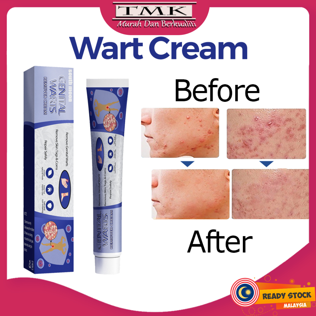 Corn Skin Tag Warts Remover Ointment Wart Cream for Plantar Warts ...