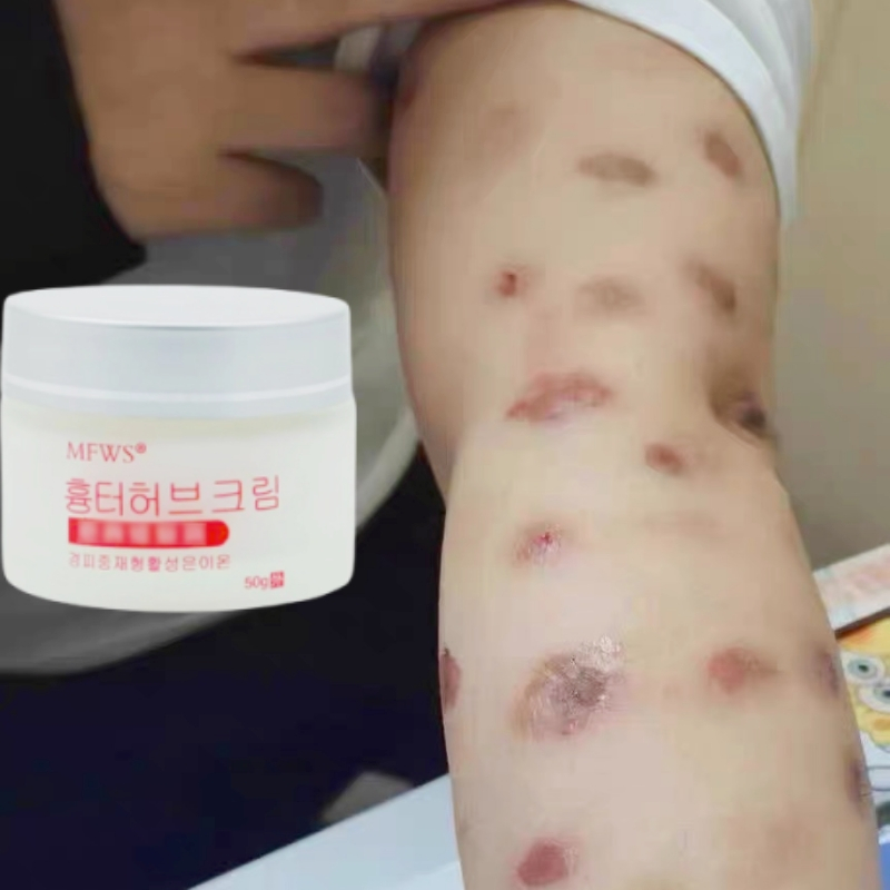 Krim hilangkan parut hitam Ubat parut kaki Menghilangkan bekas luka ...