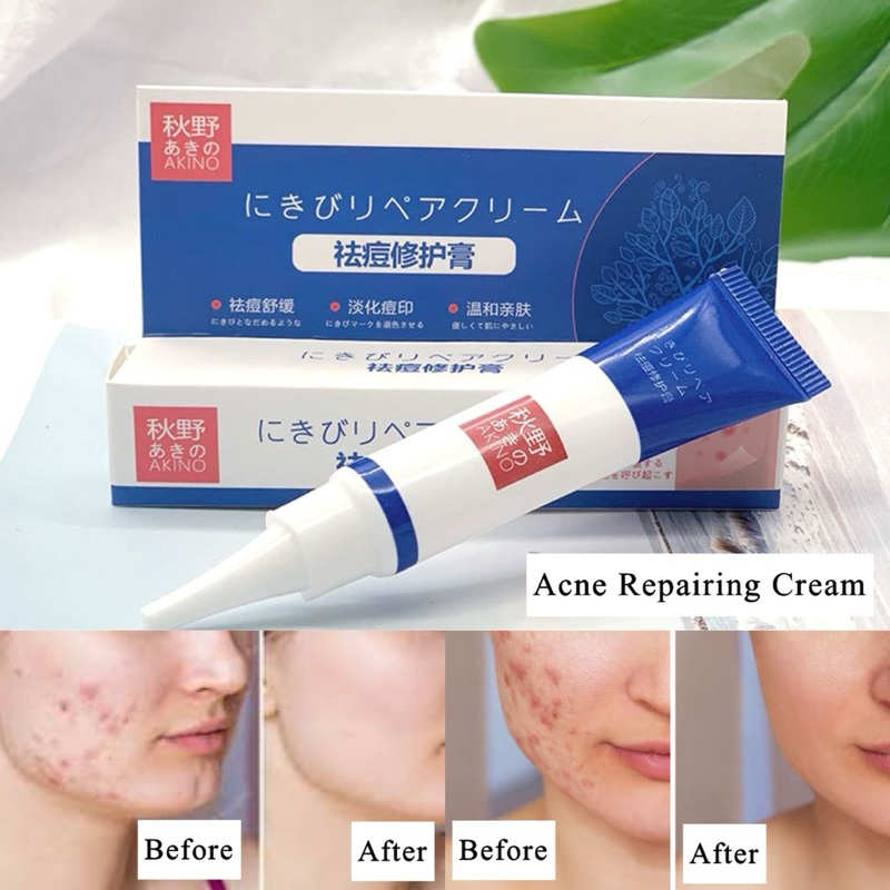 AKINO ACNE PIMPLES REMOVAL CREAM | Shopee Malaysia