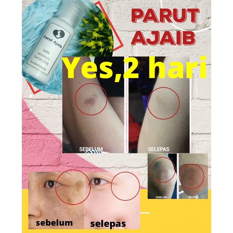 parut ajaib ,menghilangkan parut,parut lama ,parut baru ,bintik bintik ...