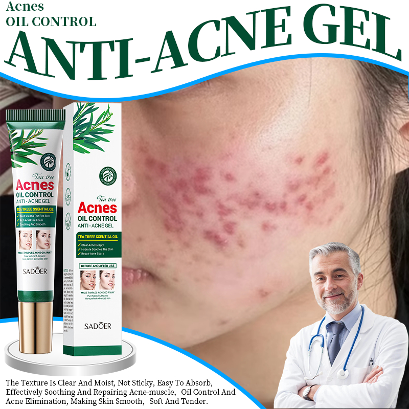 Acne gel acne cream Fast removal All types of acne hide acne adolescent ...