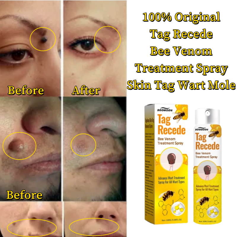 Tag Recede Ubat ketuat Skin tag remover Kutil tahi lalat removal ...