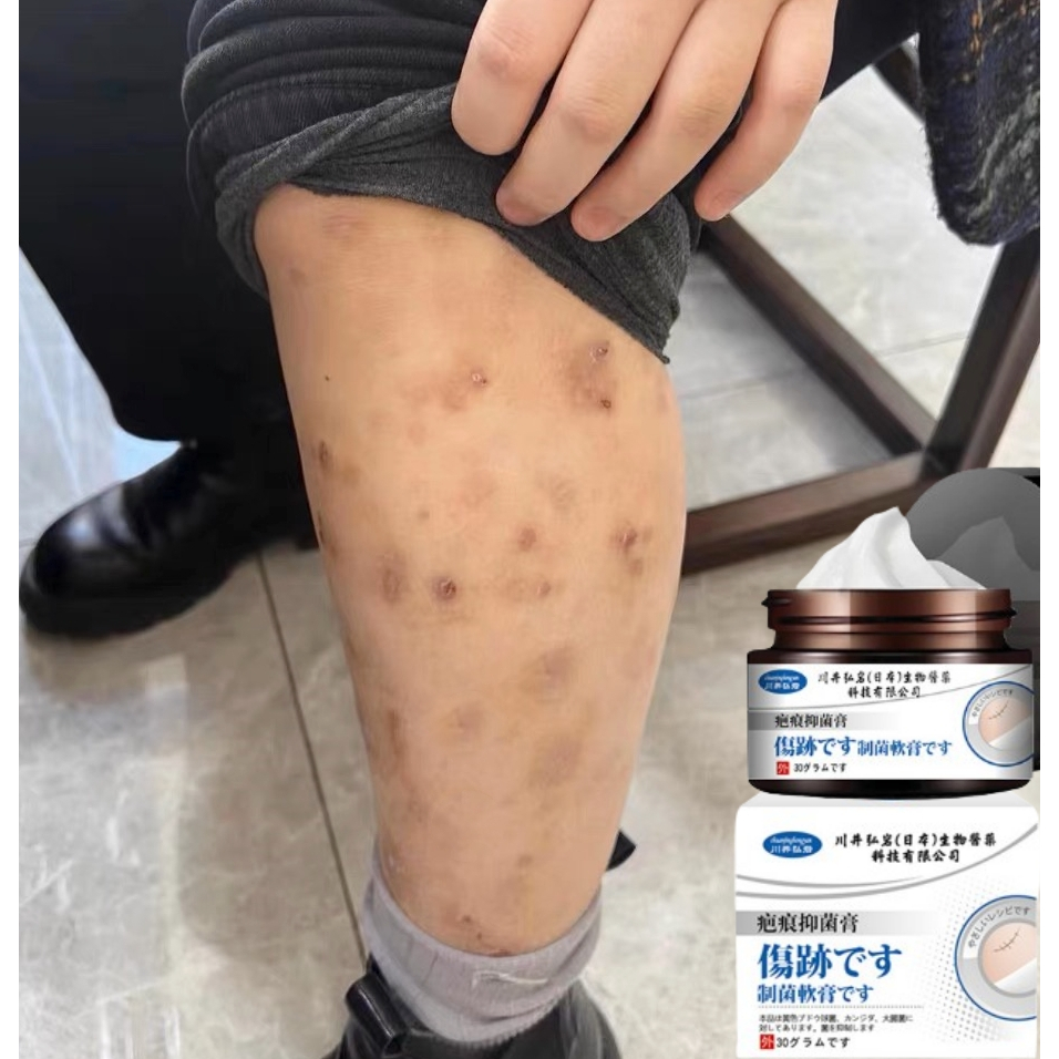 krim hilangkan parut hitam Hilangkan parut kaki Menghilangkan bekas ...