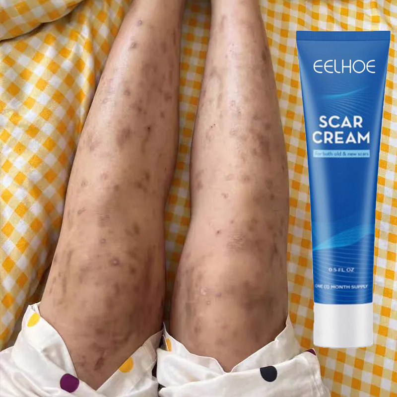 krim hilangkan parut hitam hilangkan parut kaki penghilang bekas luka ...