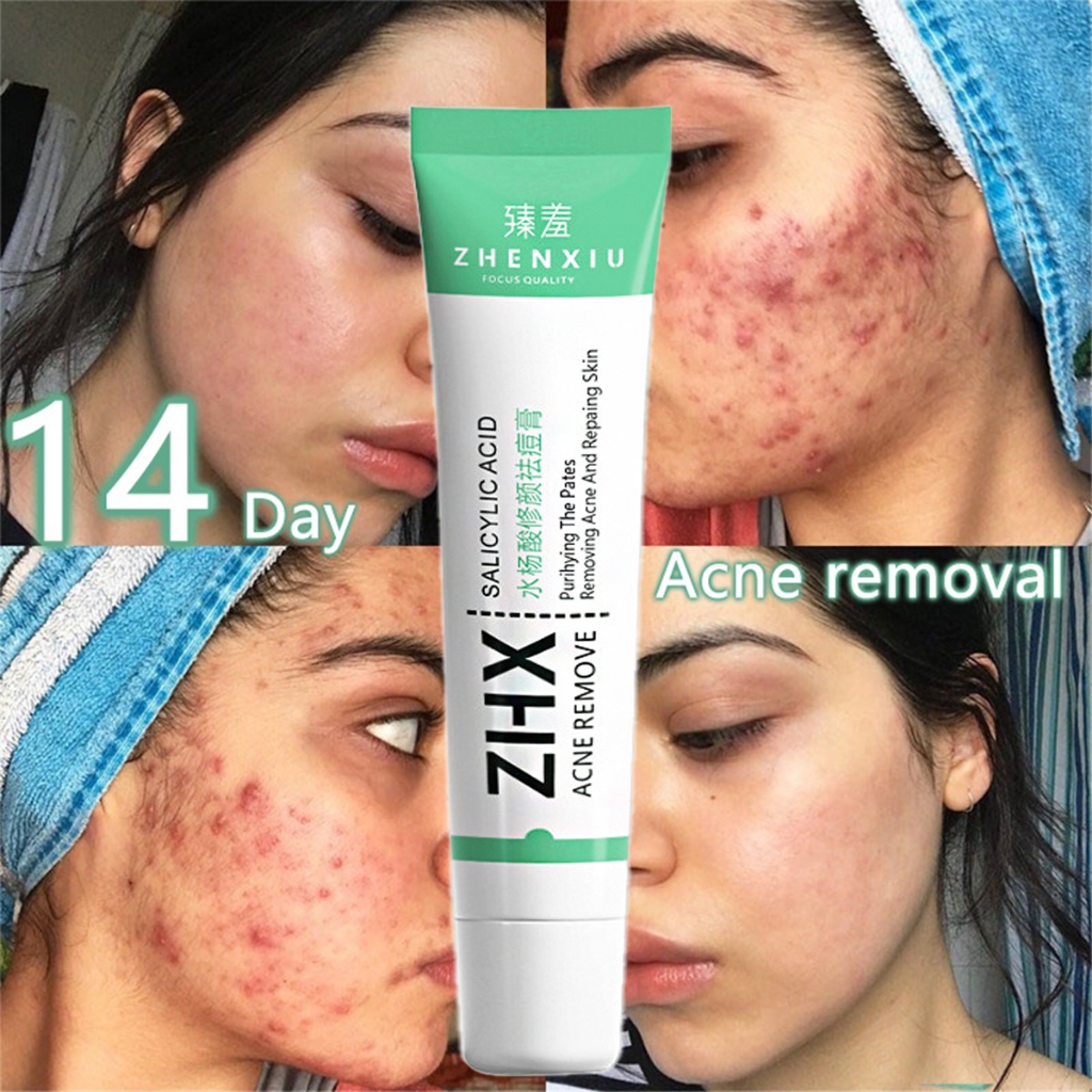 Acne Cream Krim parut Jerawat ubat jerawat muka jerawat Acne Spot ...