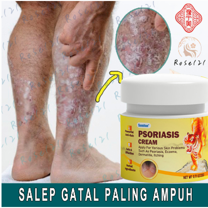 Ubat gatal Krim Remove eczema psoriasis ringworm Anti-itching ...