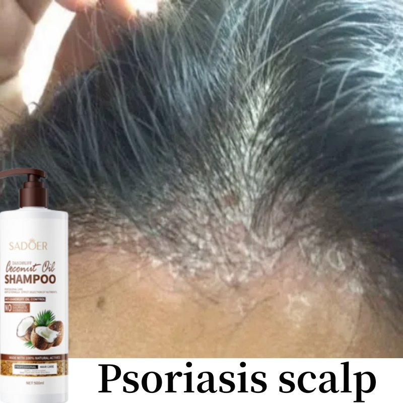 Shampoo kelemumur Rawat rambut kelemumur Kulit kepala gatal Psoriasis scalp kulit kepala kering ...