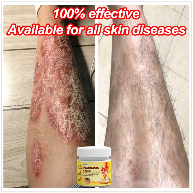 Anti-itch cream antibacterial cream cure psoriasis dermatitis blister ...