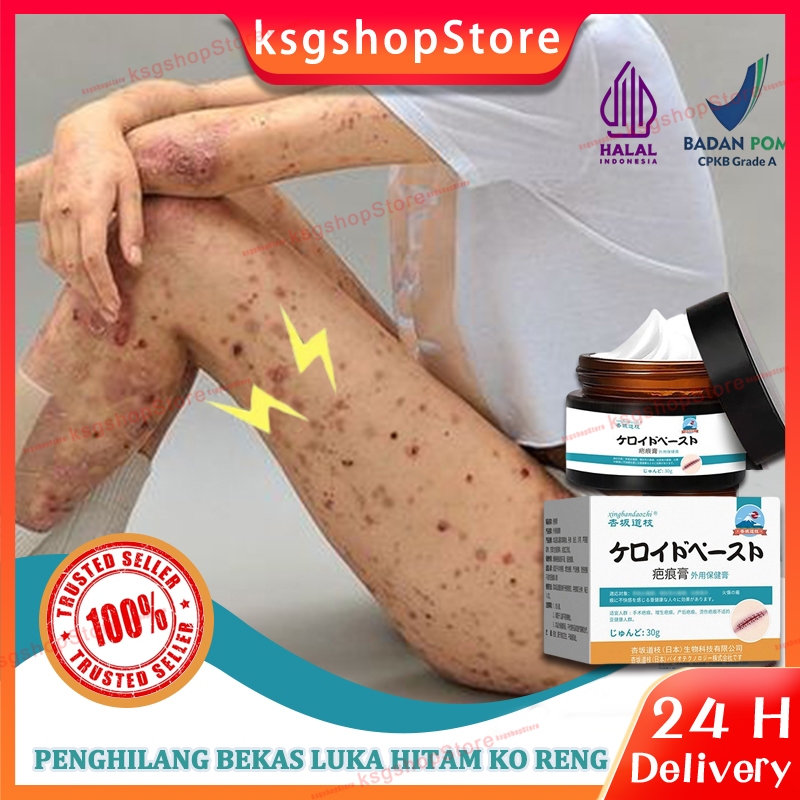Ubat parut Hilangkan parut hitam Hilangkan parut kaki Menghilangkan ...