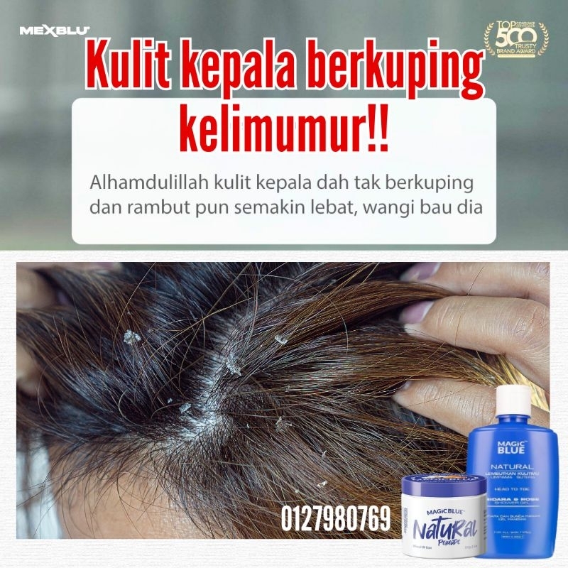 🔴 PSORIASIS KEPALA !! 🎁 + Penyakit Kulit Kepala Gatal Merenyam Kudis ...