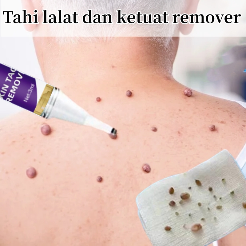Tahi lalat remover Skin tag removal Buang tahi lalat Buang kutil dan ...