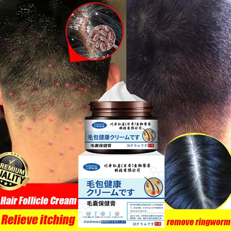 Seborrheic dermatitis cream Scalp treatment psoriasis Folliculitis hair ...