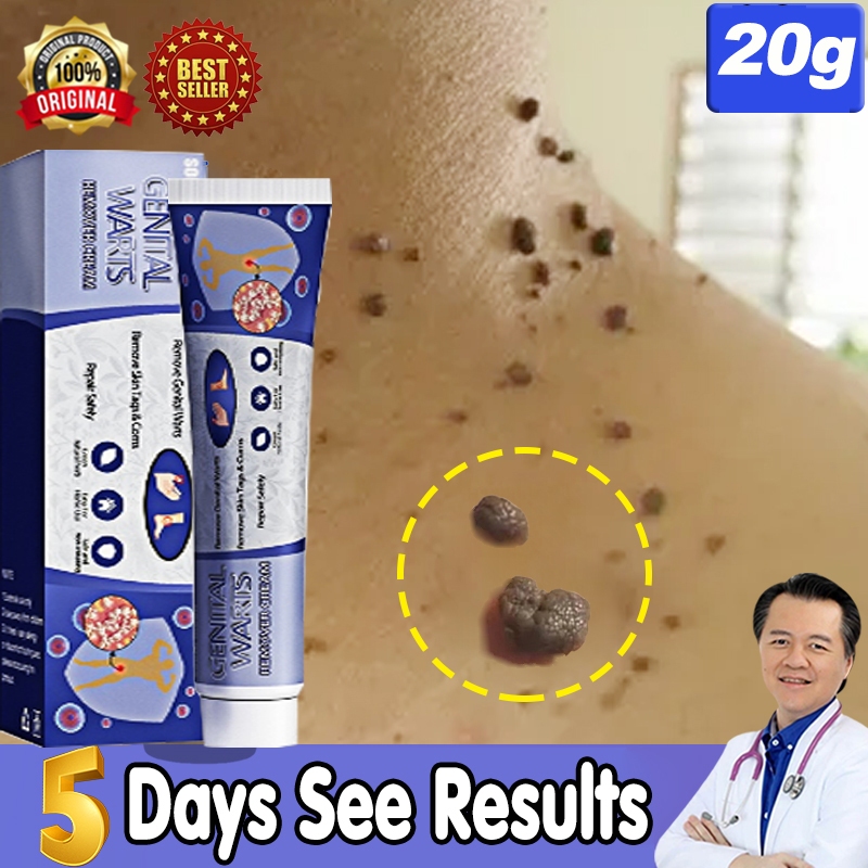 Wart Drugs Warten Mole Cholesterol Mole Removal Wart Cream Wart Removal ...
