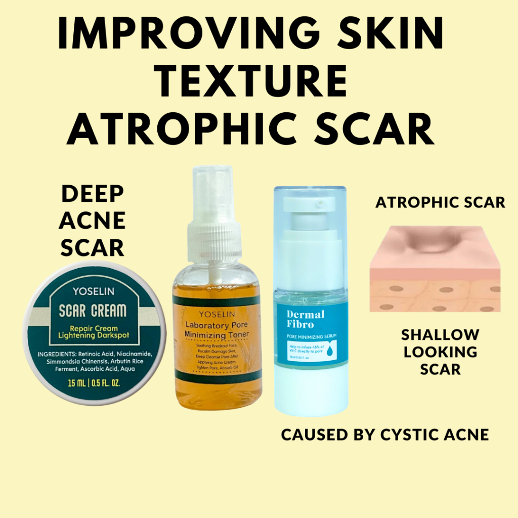 [RECOMENDED] PARUT LEKUK Yoselin® Painless Deep Acne Scars Treatment ...