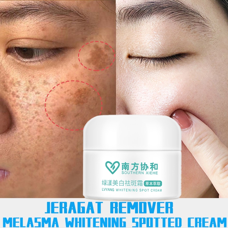 Whitening Freckle Remover Cream/Krim jeragat 祛斑霜 Pigmentation Remover ...