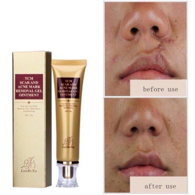 LANBENA CREAM krim anti parut penghilang parut lama dan baru selulit ...