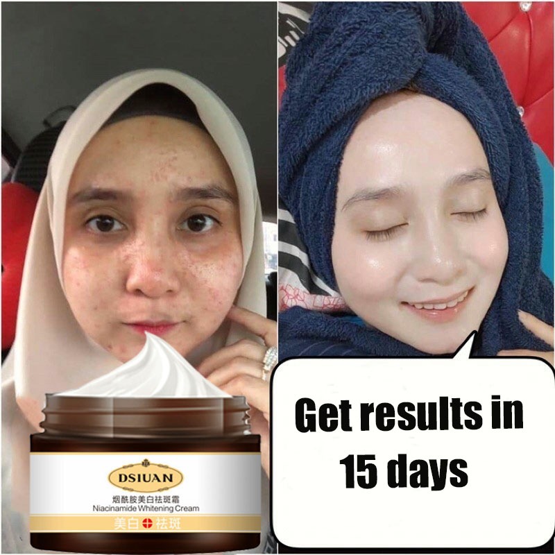 Whitening and anti-freckle cream removes chloasma, freckles, lightens ...
