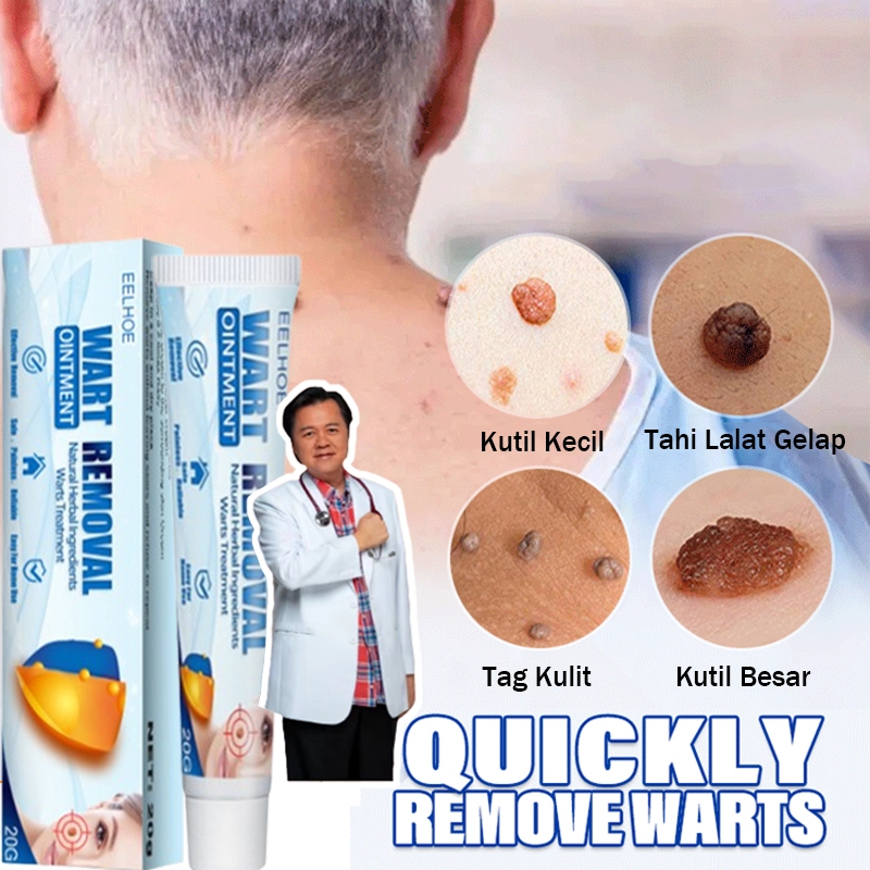 EELHOE Wart Removal Cream 20g Ubat Ketuat Ubat Kutil Mole Remover Cream ...