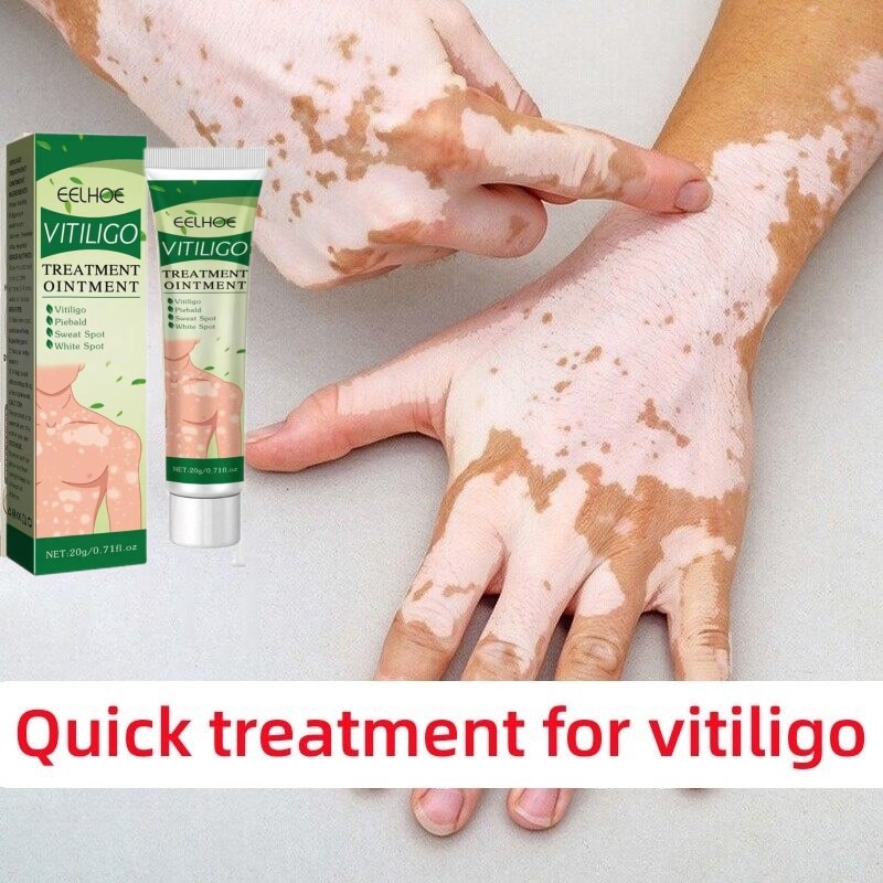 Vitiligo Repair Cream Ointment Remove White Spot Removal Skin White ...