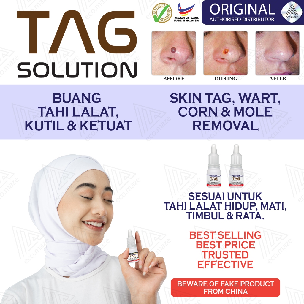Skin Tag, Mole, Wart & Corn Removal 8ml - Buang Tahi Lalat, Ketuat ...