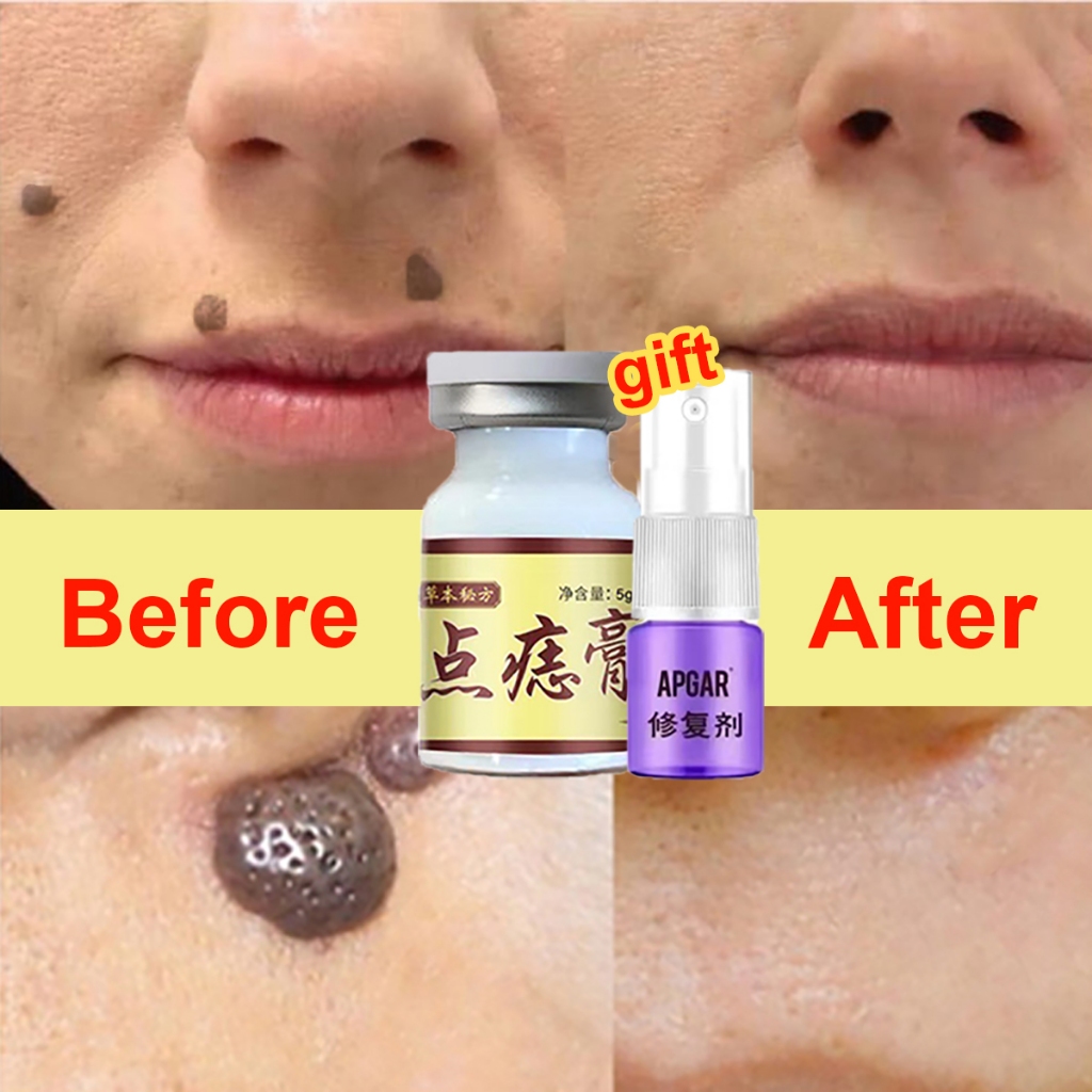 Warts removal cream ubat kutil tahi lalat ketuat dan biji kolesterol ...