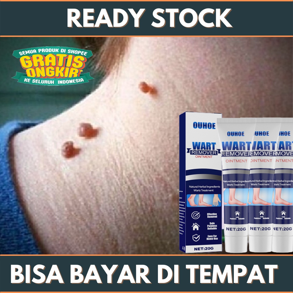 Ubat ketuat Tahi lalat remover Buang tahi lalat dan kutil Biji ...