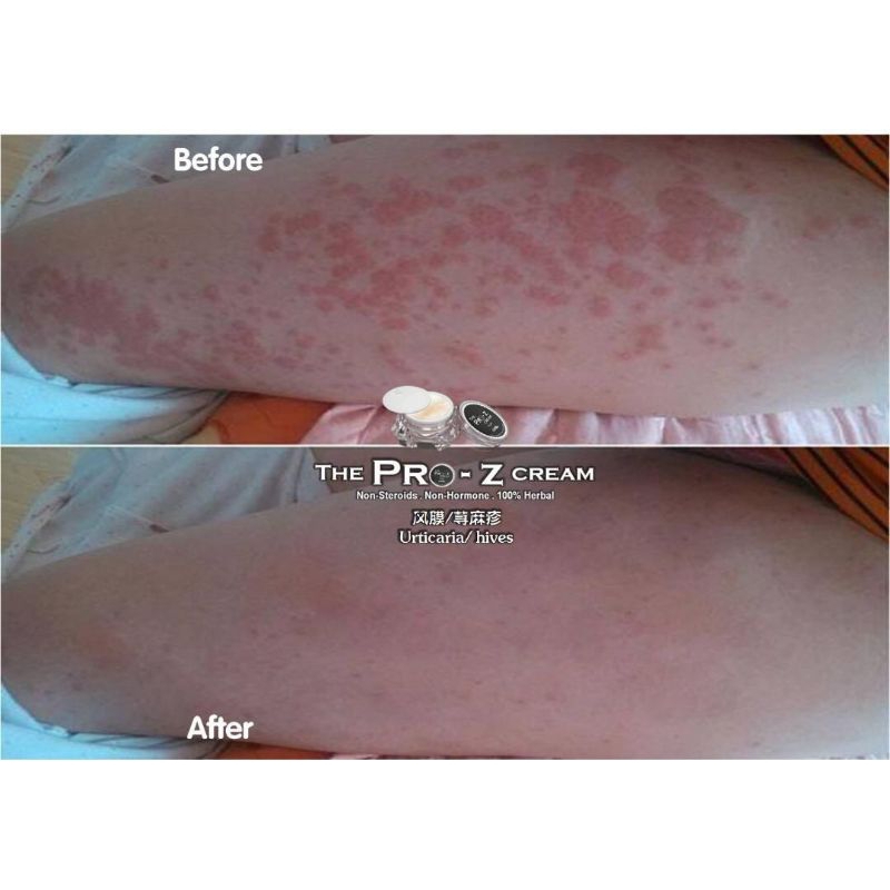 THE PROZ CREAM 500gram 牛皮癣/ 湿疹/皮肤病99%断根 500GRAM -KRIM EKZEMA/ KURAP (99 ...