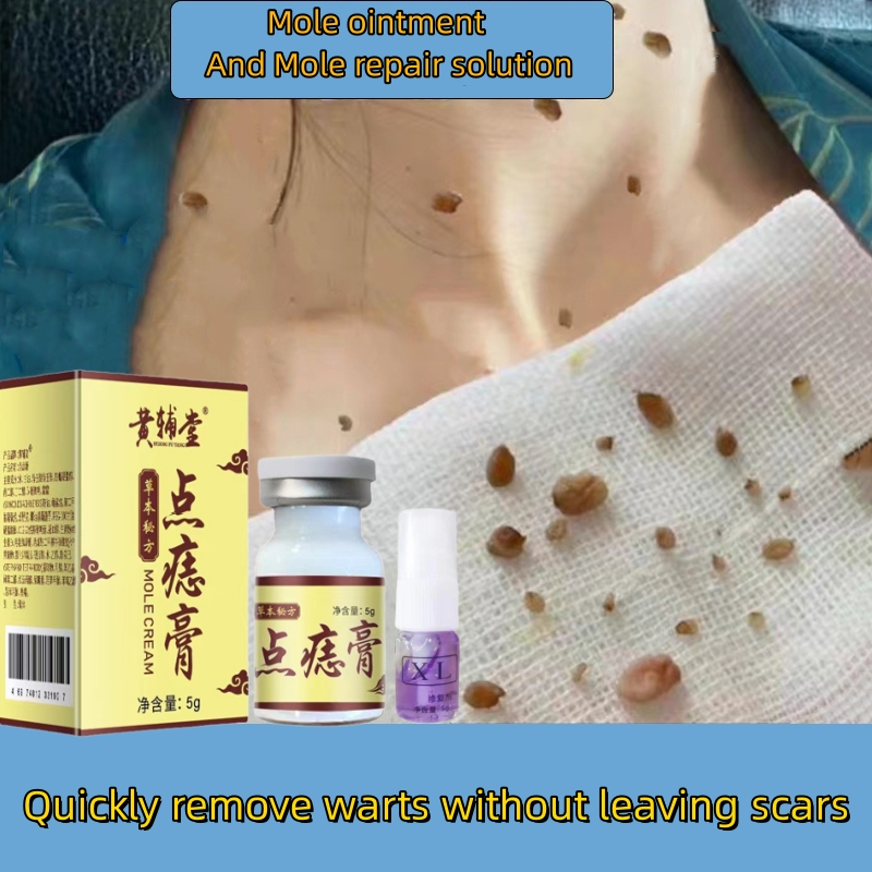 ubat kutil tahi lalat ketuat dan biji kolesterol Warts removal cream ...