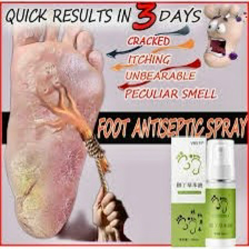 Kaki gatal makan air Foot spray herbal itchy foot worm Spray kaki ...