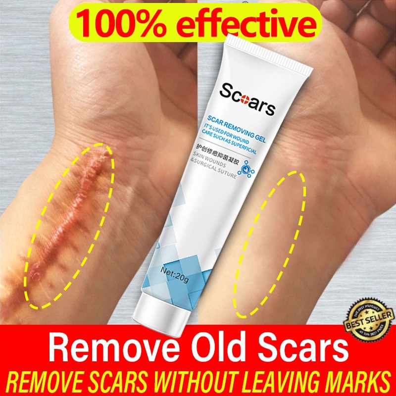 Effective Scar Removal Cream Peklat removal Stretch Mark cream old Scar ...