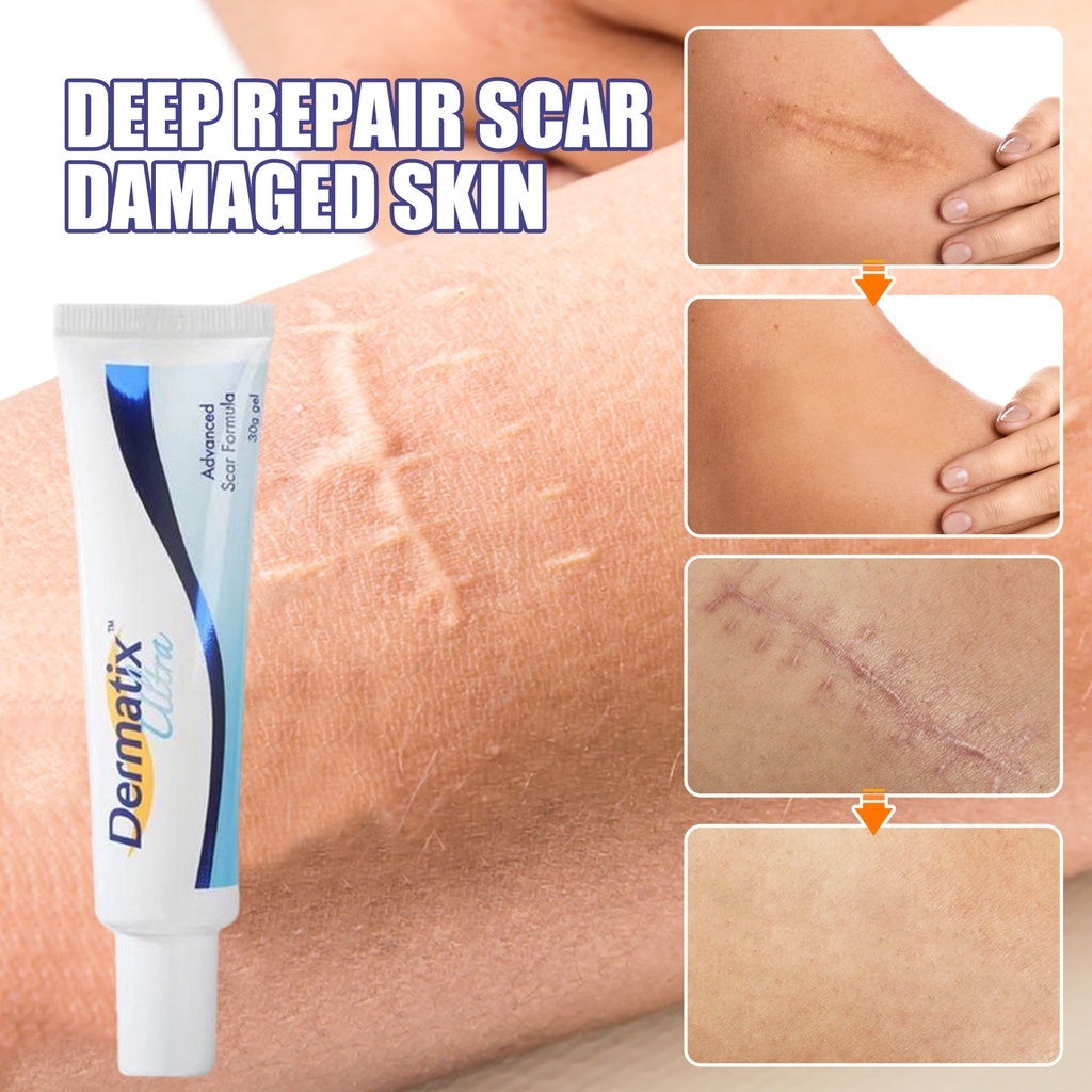 Australia Dermatix Scar Gel Acne Scars Treatment Scar Removal Cream ...