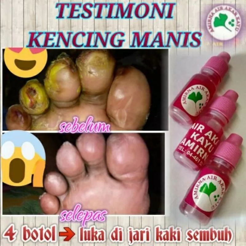 🔥 BEST SELLING!! 🎁 + Air Akar Kayu luka kencing manis diabetes | Shopee ...