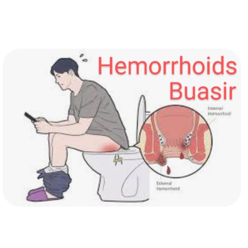 DMSO Hirudin Cream for Hemorrhoids | Buasir, Vericose Veins, Legs and ...