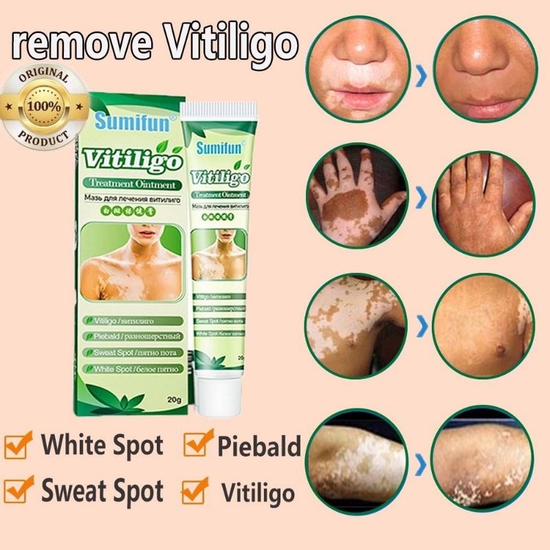 SUMIFUN VITILIGO TREATMENT OINTMENT Krim anti vitilogo/panau/tompok ...