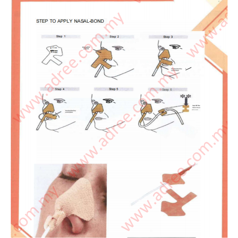 Medicos Nasal Bond - Nasal Tube Securement Tape / Plaster for Ryles ...