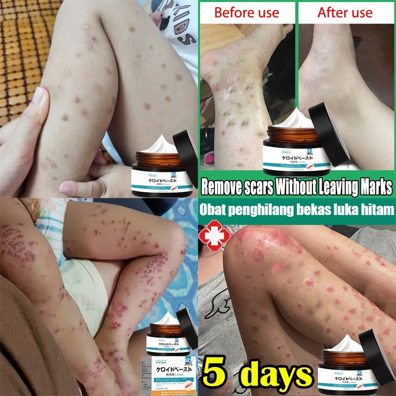 Ubat parut Hilangkan parut hitam Hilangkan parut kaki Menghilangkan ...