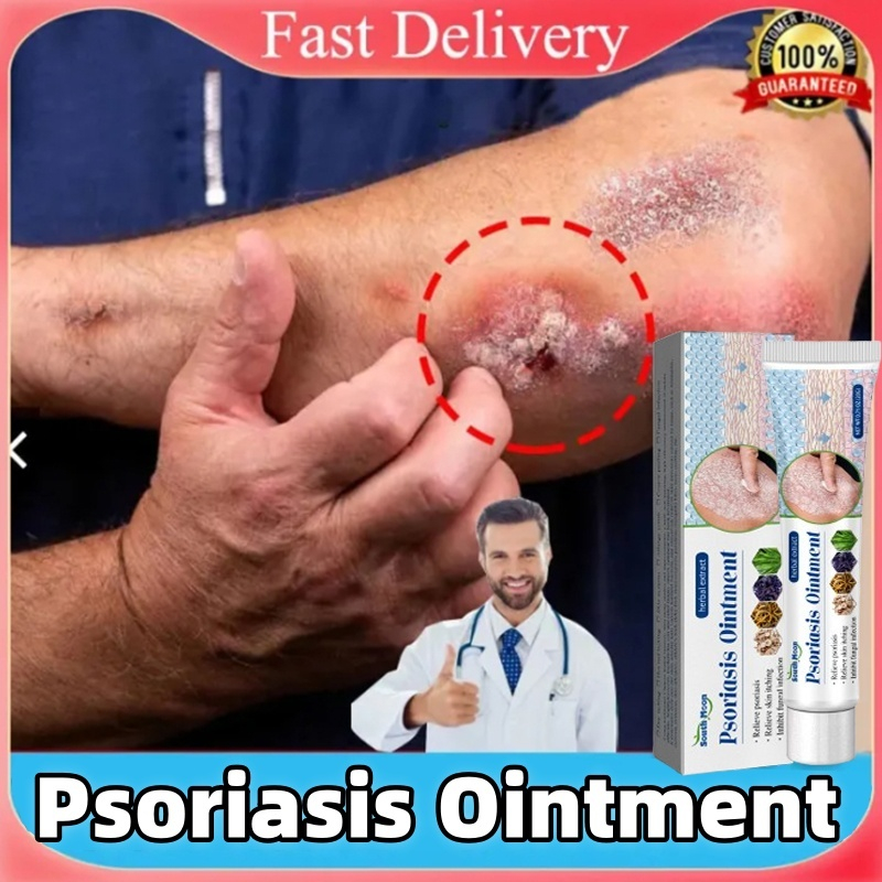 Psoriasis Ointment Eczema Ointment Anti-Itch Krim Gatal Kulit Ubat ...