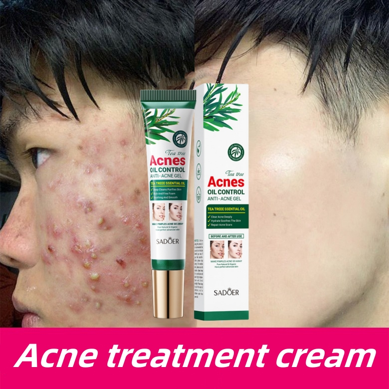 Acne cream Krim Jerawat ubat jerawat berkesan Pimple cream Acne ...