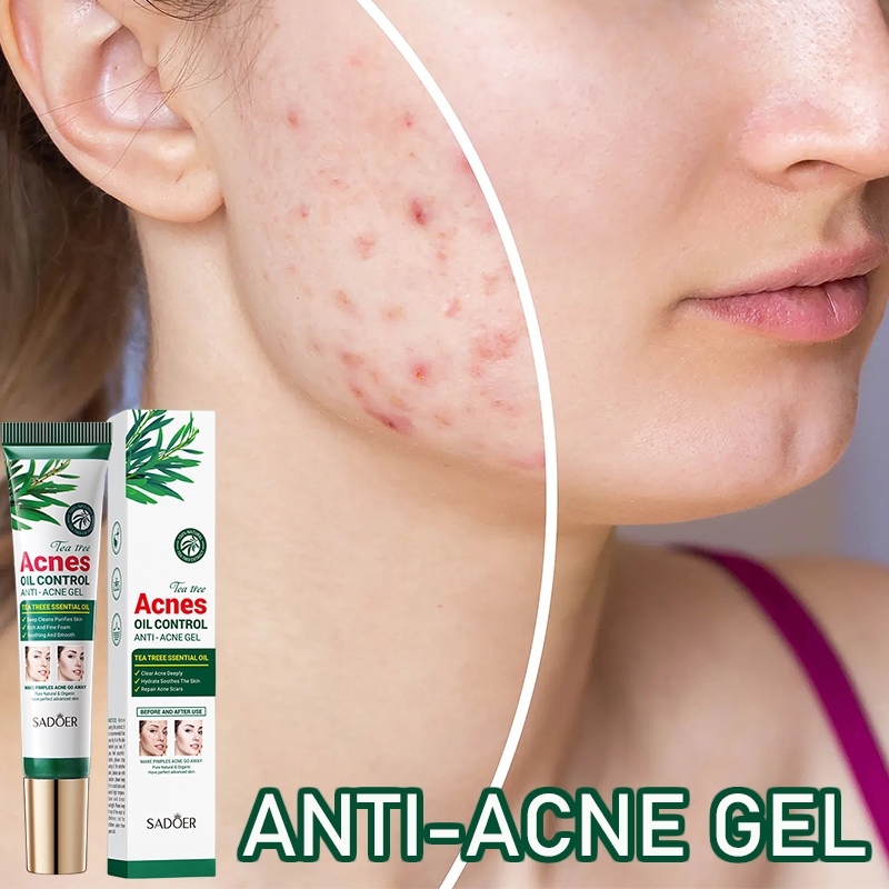 ubat jerawat acne spot treatment tea tree pimple cream hilangkan parut ...