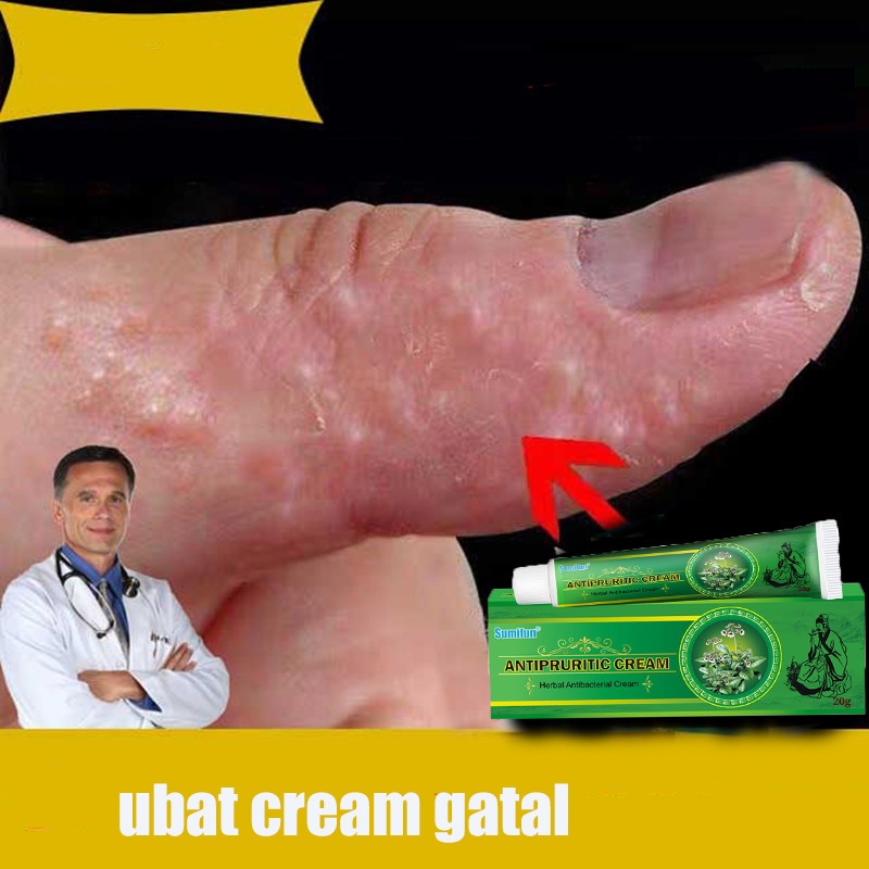 ubat cream gatal ubat gatal celah kangkang eczema psoriasis cream Ubat ...
