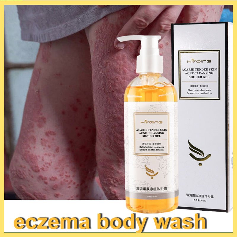 eczema body wash Psoriasis body wash Acne body wash 260ml Removing ...