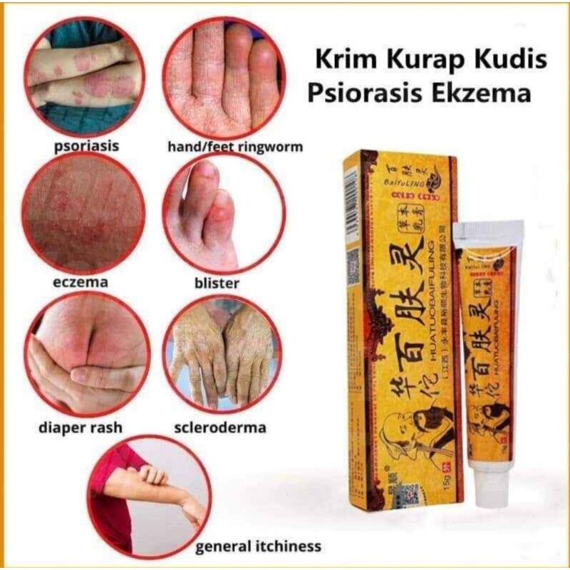 psoriasis ringworm Eczema Scabies Itchy Ringworm Red Rashes gatal kudis ...