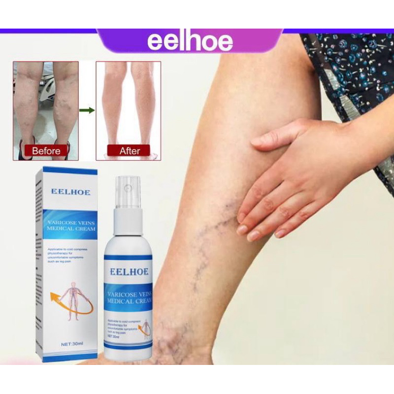 SPRAY Terapi rawatan urat kaki lengan peha kurangkan bengkak ...