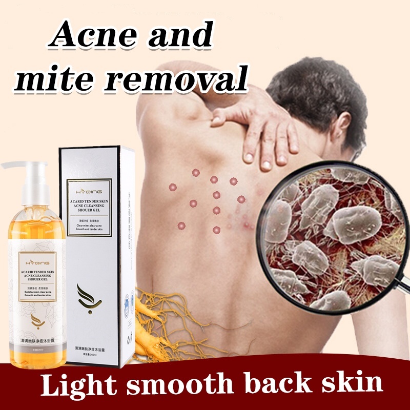 (Local Seller) Anti-Mite Shower Gel Acne Body Wash antibacterial Mite removal 260ml Personal ...