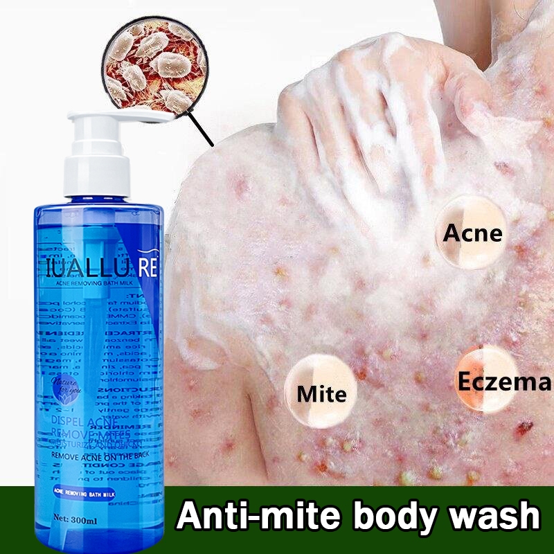 Acne soap Acne body wash 300ml Jerawat ubat mandian badan 除蟎沐浴露 Back ...