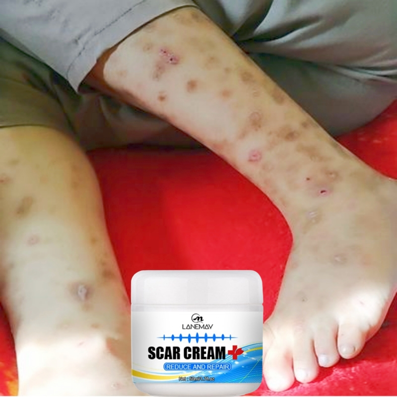 Ubat parut Hilangkan parut kaki hilangkan parut kudis dan parut hitam ...